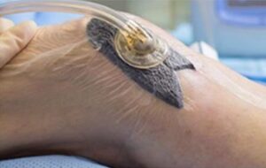 Wound Vac | Shirah Surgical